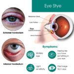 What Is an Eye Stye? Causes, Symptoms, and Effective Treatment
